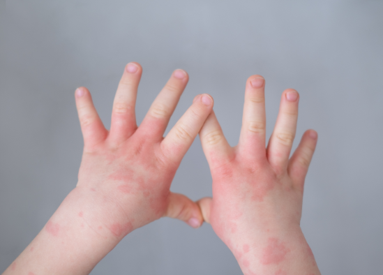 Egzema – objawy i sposoby leczenia | Eloderm